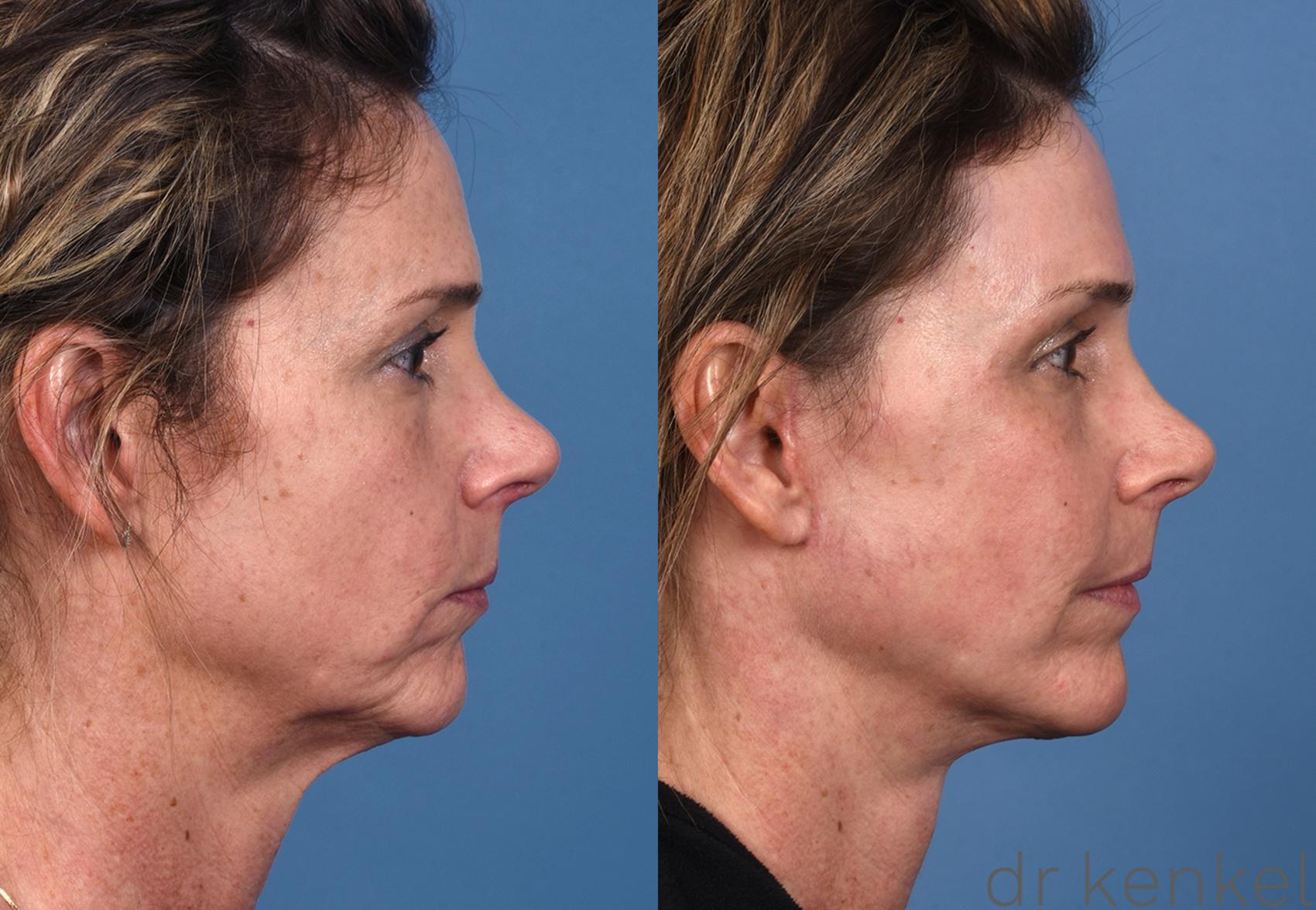 Facial Rejuvenation