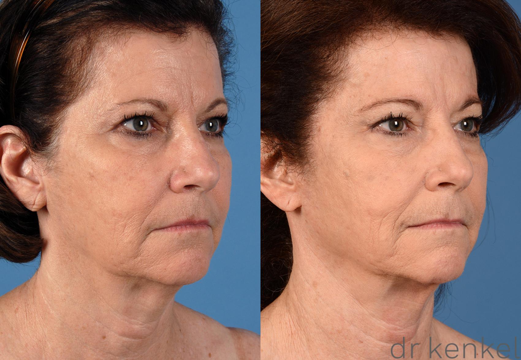 Injectables Case #246