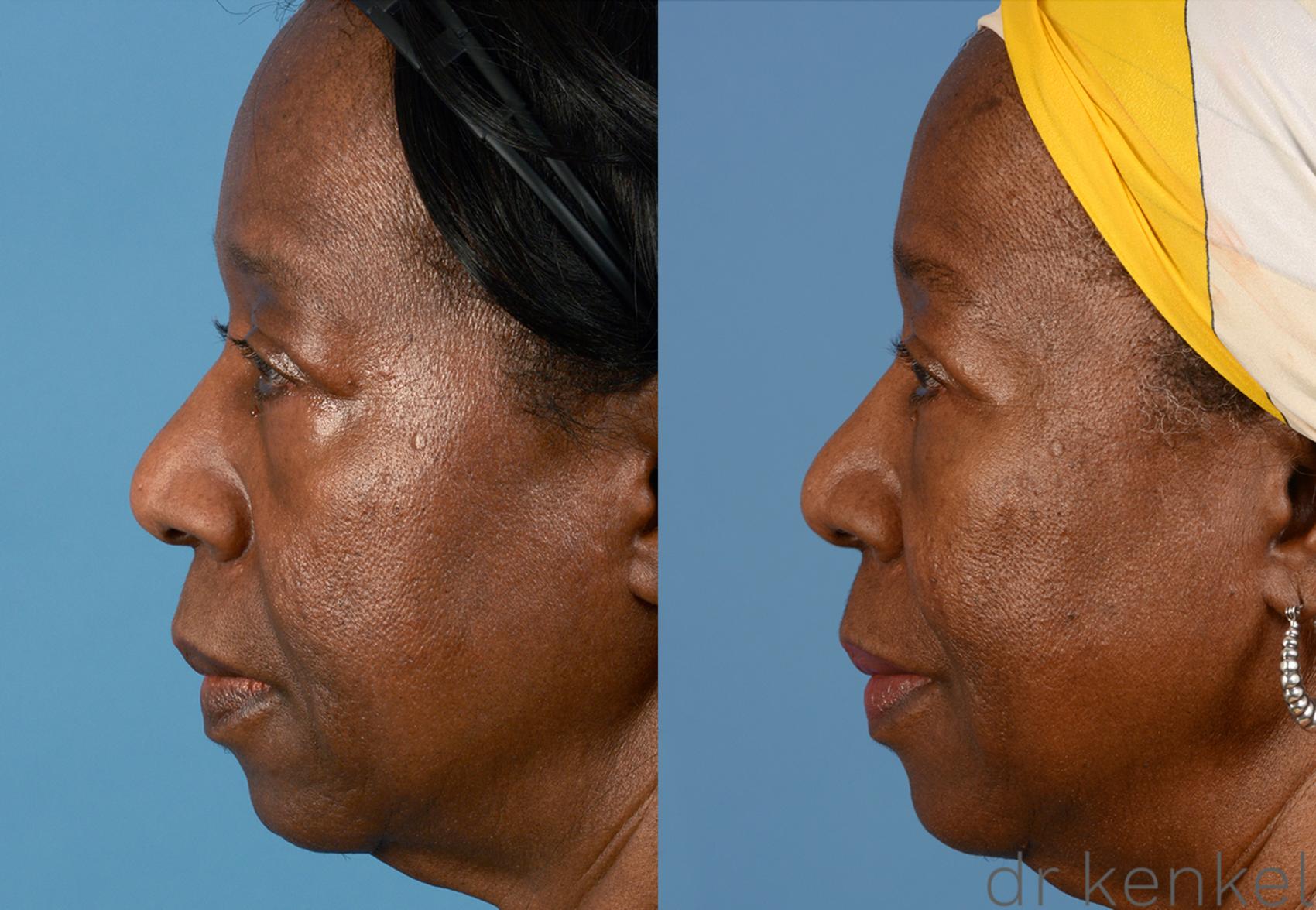 Injectable Fillers Case #315