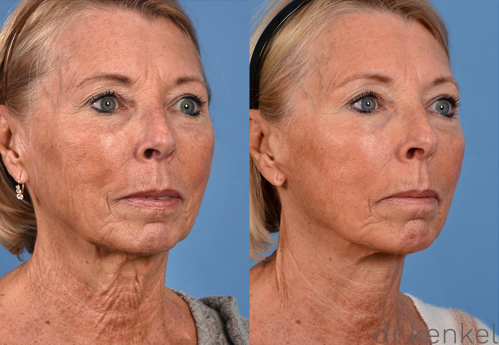 Neck Lift Before and After Pictures Case 334 | Dallas, Frisco, McKinney ...