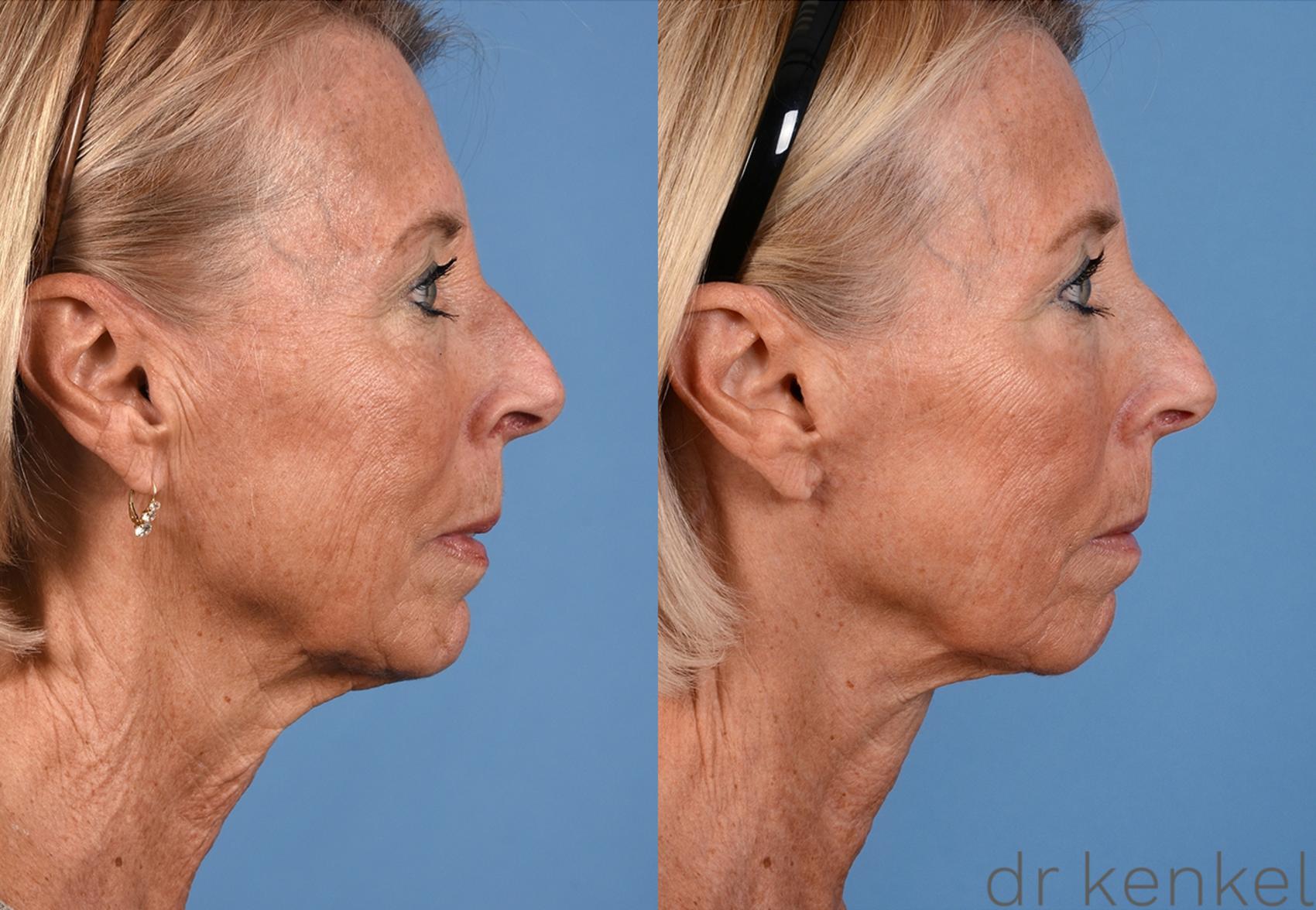 Neck Lift Before and After Pictures Case 334 | Dallas, Frisco, McKinney ...