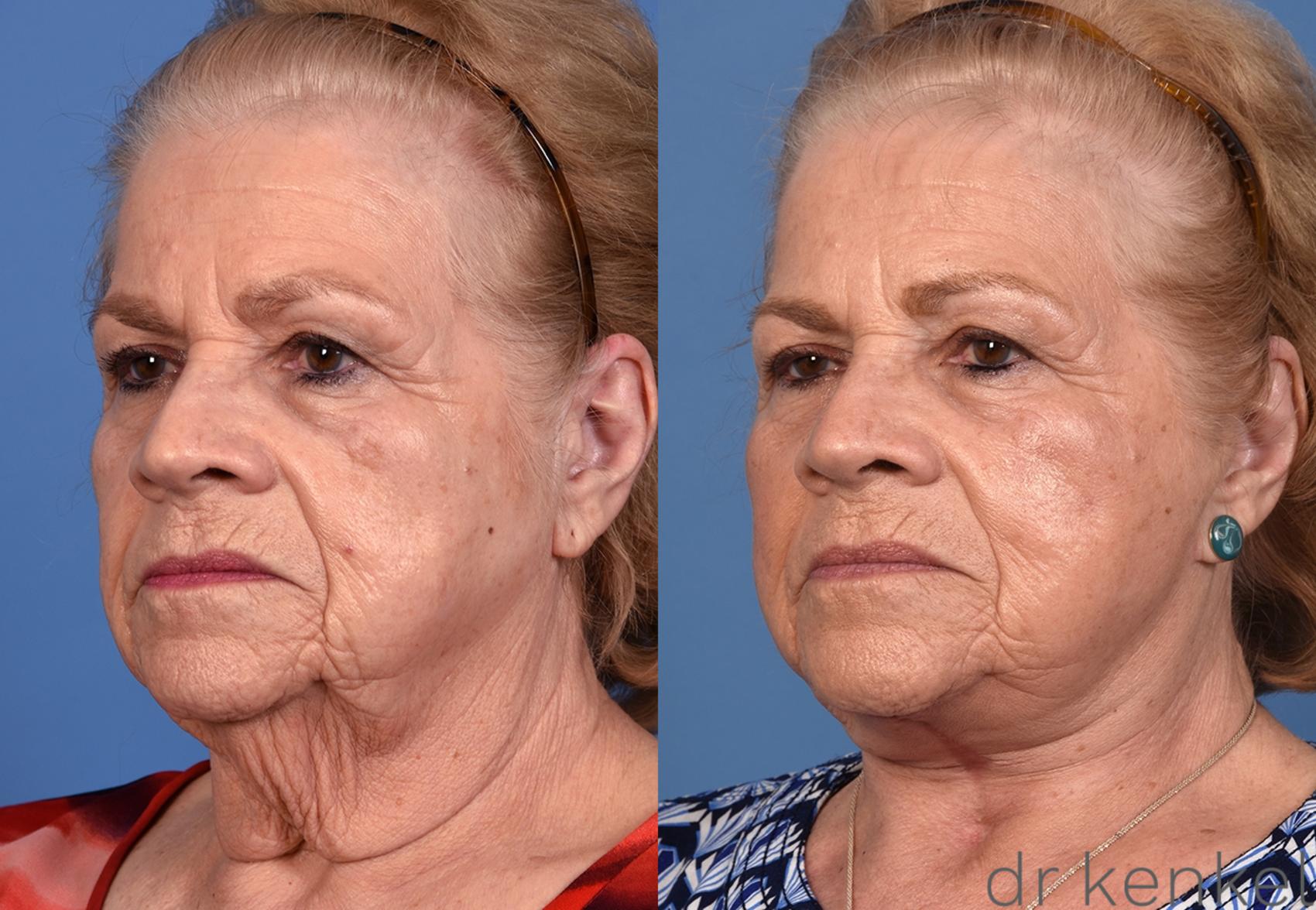 Neck Lift Before And After Pictures Case 335 Dallas Frisco Mckinney Prosper Allen Celina