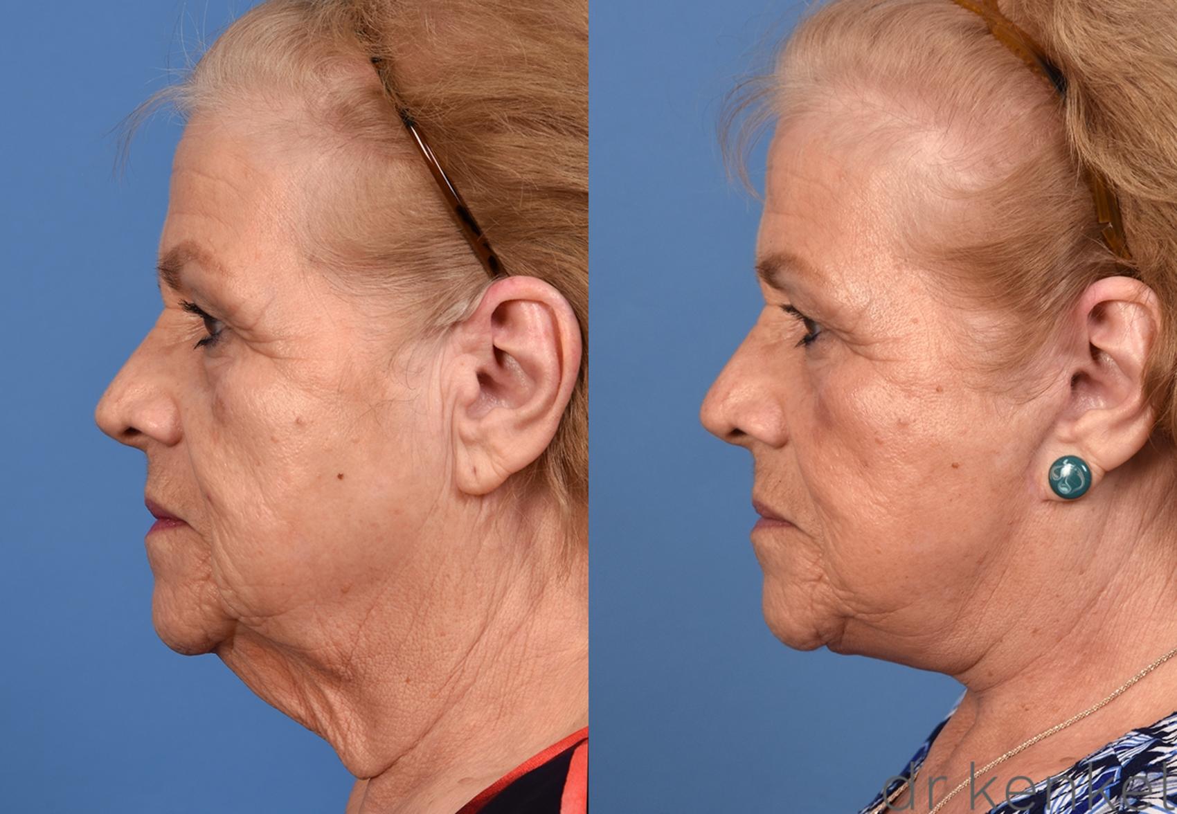 Direct Neck Excision Before and After Pictures Case 335 | Dallas ...