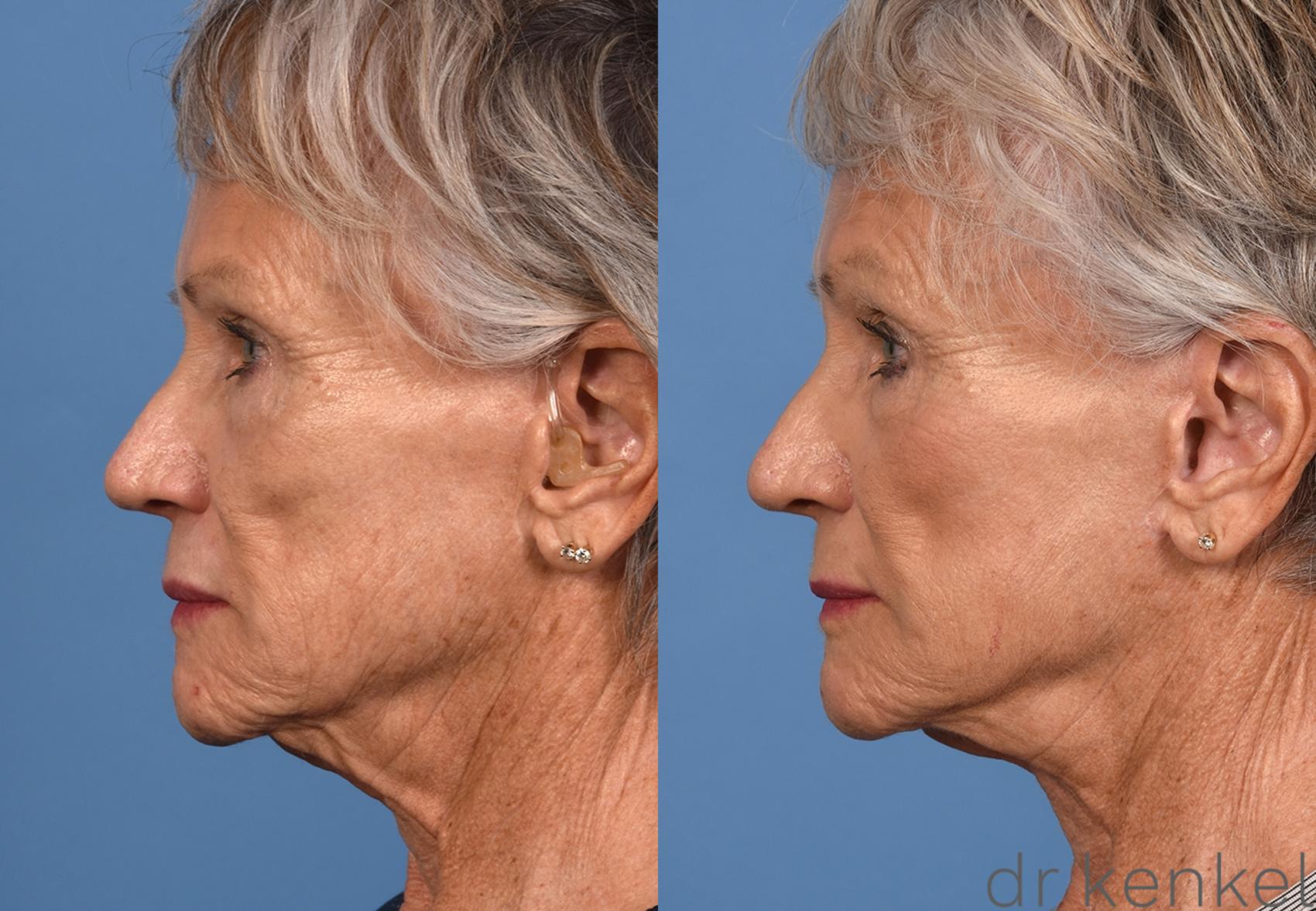 Neck Lift Before and After Pictures Case 338 | Dallas, Frisco, McKinney ...